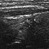 Ultrasound-Guided Laser Thermal Ablation and Goiter - Page 3