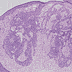 Fibroepithelioma of Pinkus Presenting as a Sessile Thigh Nodule