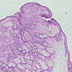Fibroepithelioma of Pinkus Presenting as a Sessile Thigh Nodule