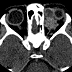 A Child With Acute Unilateral Proptosis