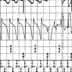 Antitachycardia Pacing for Ventricular Tachycardia - Page 7