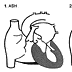 Obstructive Hypertrophic Cardiomyopathy
