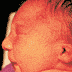 Recognizing the Clinical Features of Trisomy 13 Syndrome - Page 7