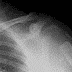 Neuropathic Arthropathy of the Shoulder (Charcot Shoulder)