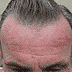 Dermatitis Due to Formaldehyde Resins in Clothing