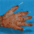 Epidermolysis Bullosa: Management of Neonate, Infant & Child