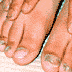Twenty-Nail Dystrophy Originating From Lichen Planus