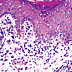 Twenty-Nail Dystrophy Originating From Lichen Planus