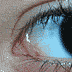 Conjunctival Mass Following Strabismus Surgery - Page 2