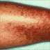 Overview of Hepatitis C and Skin - Page 4