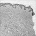 Case Study on Linear Focal Elastosis