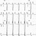 The Resting Electrocardiogram in the Management of Patients With CHF