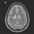 Balo's Concentric Sclerosis Presenting as a Stroke-like Syndrome