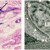 Typical Progression of Myoclonic Epilepsy of the Lafora Type: A Case ...