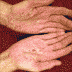Hand Dermatitis: Clinical Features, Diagnosis, and Management - Page 6
