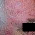 What Do Pathologic Skin Lesions in Elderly Patients Look Like?