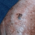 What Do Pathologic Skin Lesions in Elderly Patients Look Like?