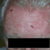 What Do Pathologic Skin Lesions in Elderly Patients Look Like?