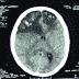 Herpes Simplex Virus Encephalitis During Immunosuppressive Treatment of ...