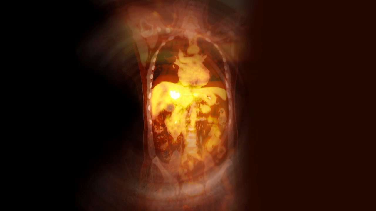 Chondrosarcoma: Practice Essentials, Pathophysiology, Epidemiology