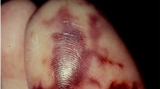 Sulfamylon (mafenide) dosing, indications, interactions, adverse ...