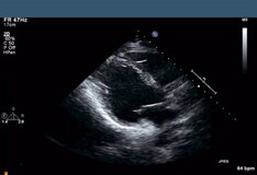 Chronic Megacolon: Background, Pathophysiology, Etiology
