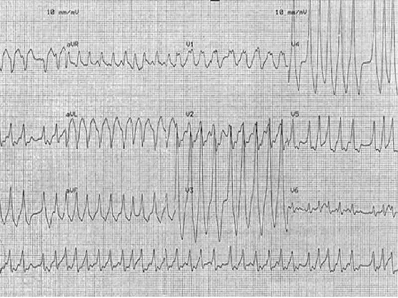 Atrial Fibrillation Center of Excellence | Medscape