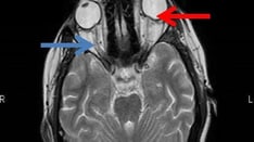 Functional MRI Shows Brain Damage From Lead Poisoning in Early Childhood