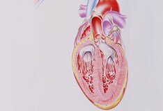 Evaluation and Management of Pericarditis