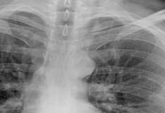 Boerhaave Syndrome: Background, Pathophysiology, Etiology