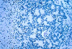 CREST Syndrome Clinical Presentation: History, Physical Examination ...