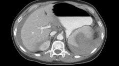 Signs and Symptoms of Joubert Syndrome