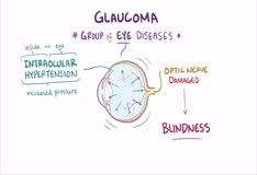 Primary Open-Angle Glaucoma (POAG): Practice Essentials, Background ...