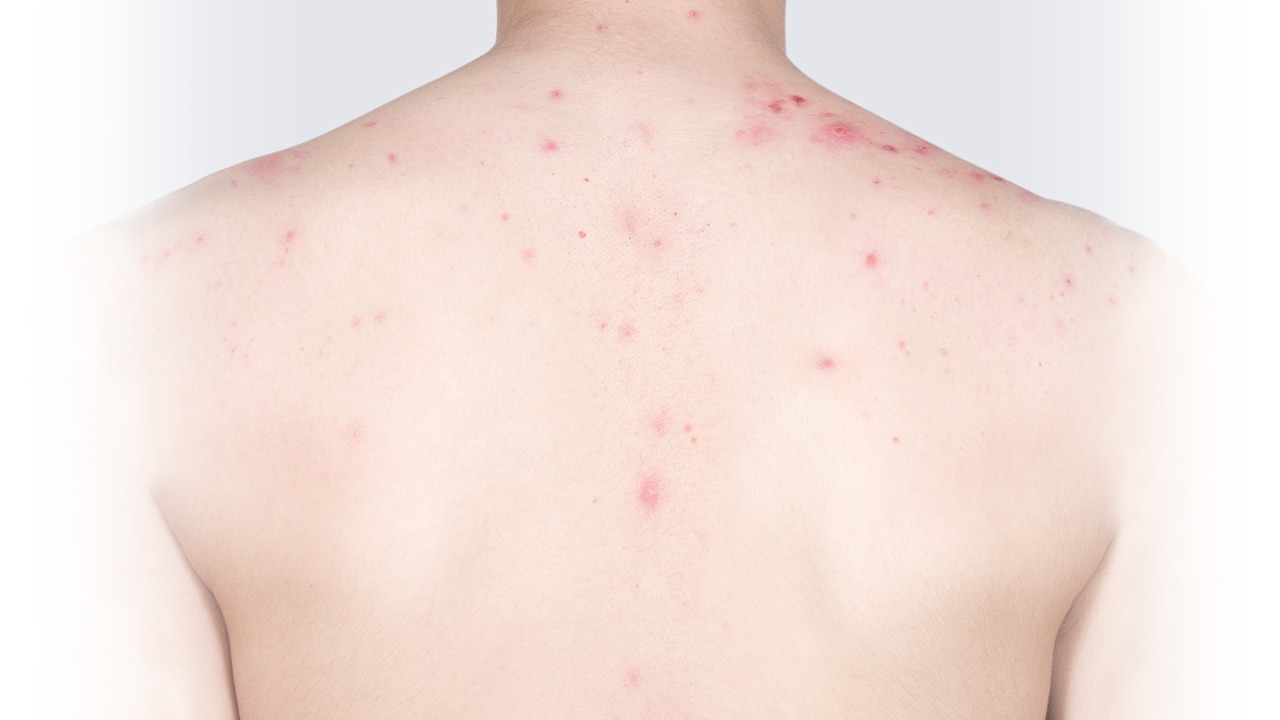 Acne Vulgaris: Practice Essentials, Background, Pathophysiology
