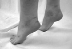 Toe Walking Treatment & Management: Approach Considerations, Medical ...