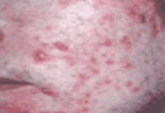 Avage, Tazorac (tazarotene topical) dosing, indications, interactions ...