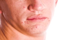 Alevicyn (hypochlorous acid) dosing, indications, interactions, adverse ...