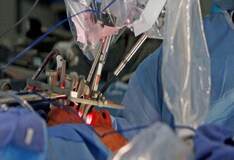 Cricopharyngeal Myotomy: History of the Procedure, Problem, Epidemiology