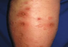 Anetoderma Clinical Presentation: History, Physical Examination, Causes