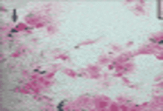 Feridex (ferumoxides) dosing, indications, interactions, adverse ...