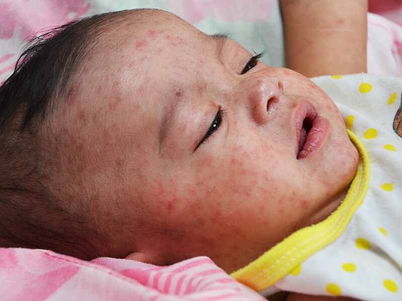 The Measles Outbreak: Guidance for Clinicians