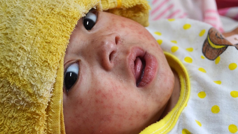 Cornea and External Disease | Medscape