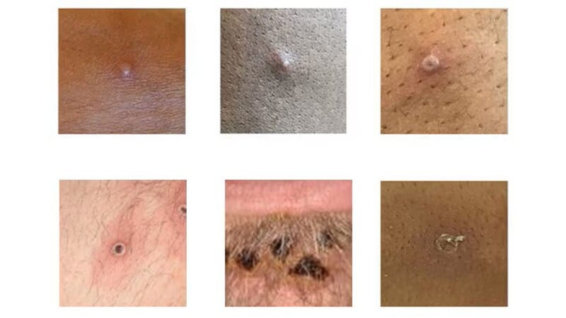 Painful Genital Lesions - Page 3