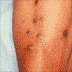 Overview of Hepatitis C and Skin - Page 4