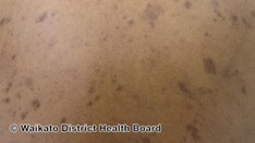 Postinflammatory Hyperpigmentation: Background, Pathophysiology, Etiology