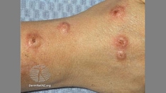 Prurigo Nodularis: Practice Essentials, Pathophysiology, Etiology