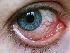 Dry Eye Disease (Keratoconjunctivitis Sicca) Medication: Ophthalmic ...