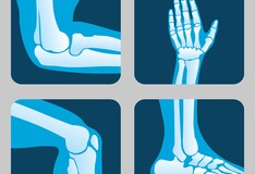 Simponi, Simponi Aria (golimumab) dosing, indications, interactions ...