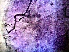 Kengreal (cangrelor) dosing, indications, interactions, adverse effects ...