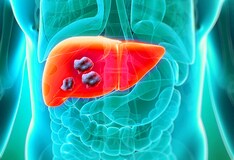 Hepatocellular Carcinoma: Background, Anatomy, Pathophysiology